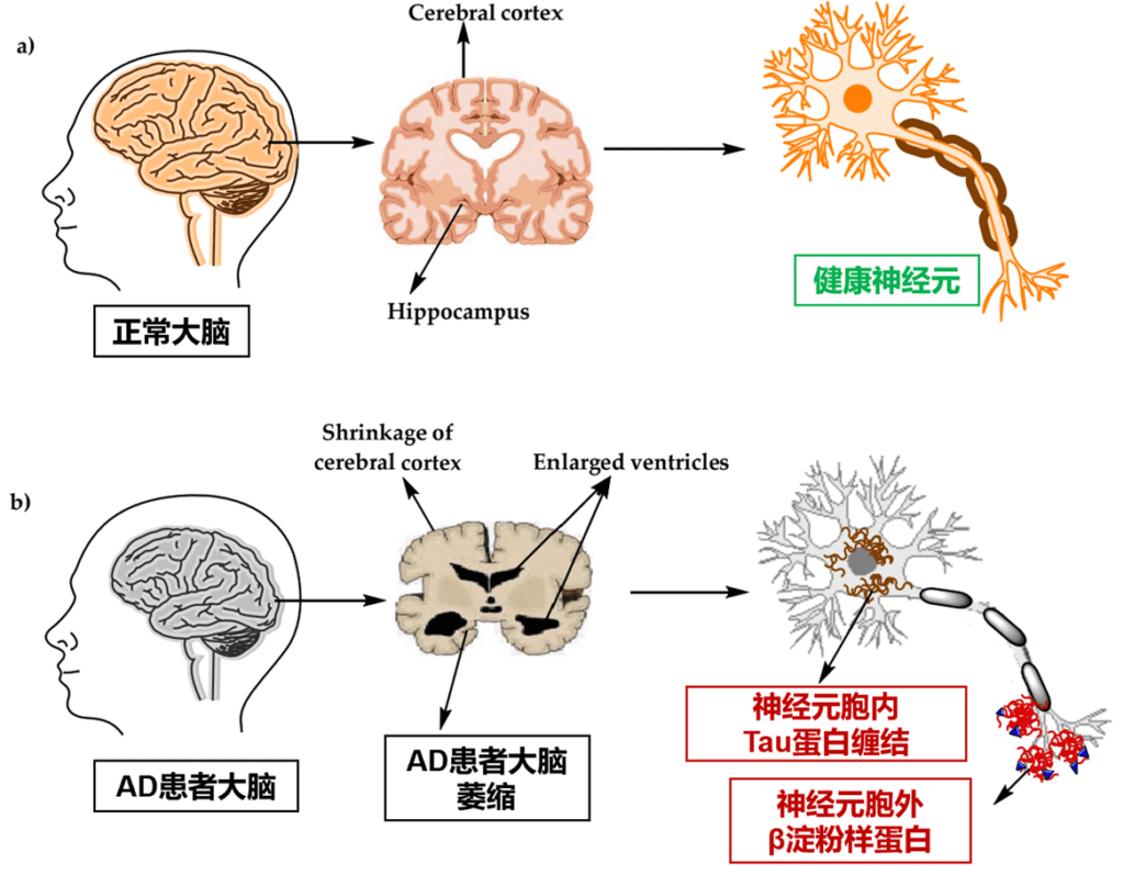 记住阿尔茨海默病生物药 Aducanumab 阿杜卡单抗 β 淀粉样蛋白拮抗剂 肖恩记药